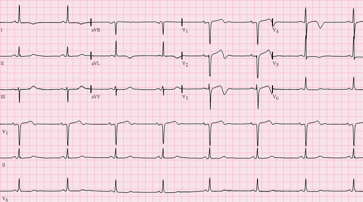 Wellens Syndrome: The Forgotten Diagnosis | ACOEP RSO