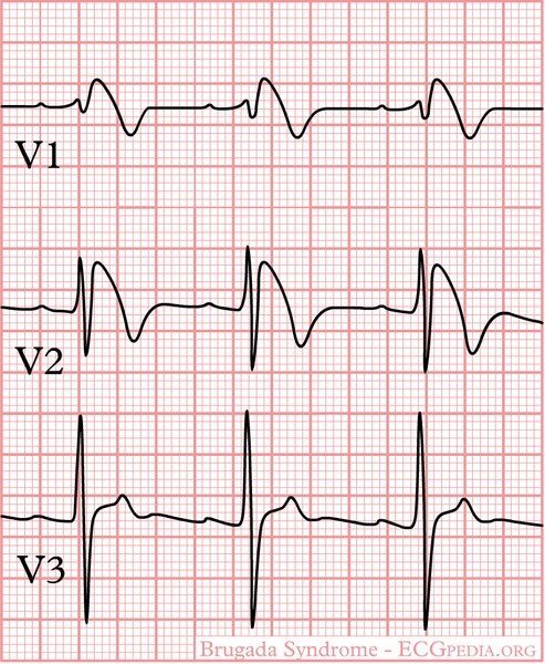 What is the Etiology of this Electrocardiogram Finding? | ACOEP RSO