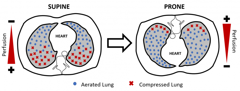Awake Proning for COVID-19 Pneumonia | ACOEP RSO
