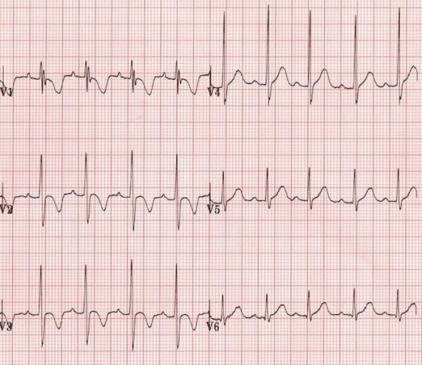 Investigating Inversions To A Tee | ACOEP RSO