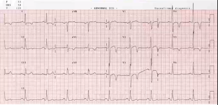 Investigating Inversions To A Tee | ACOEP RSO